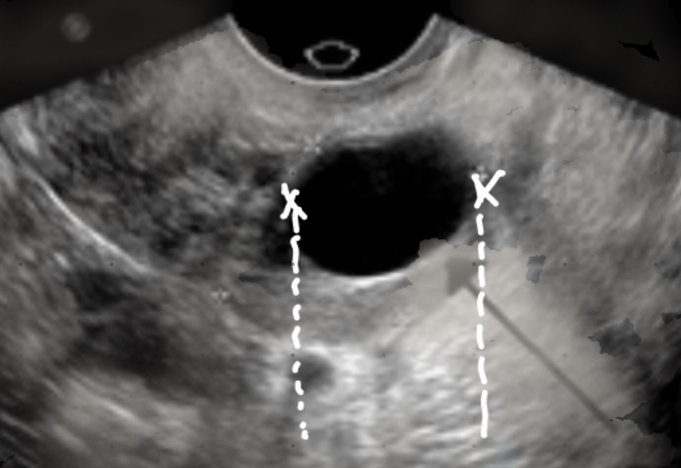 Measuring the cyst – Jo Hansen